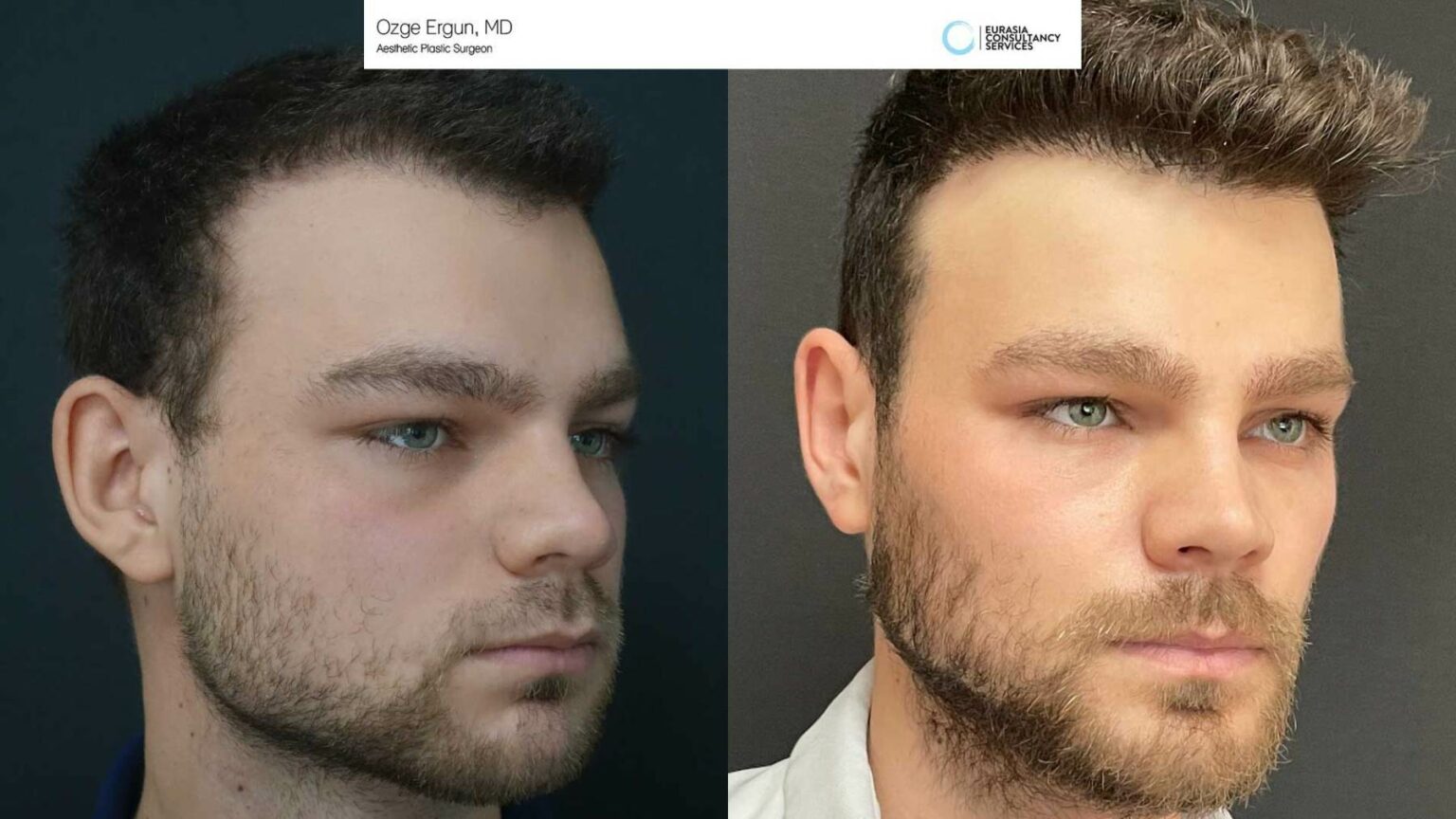 Chin & Jaw Implant - Best Medical Packages (€7.050)